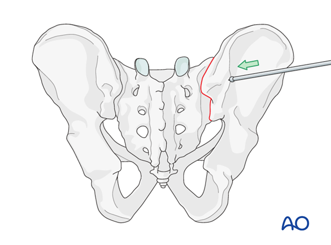 Iliosacral screw for SI joint