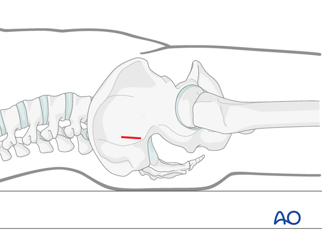 MIO - Iliosacral screw for sacrum for SI-joint fractures