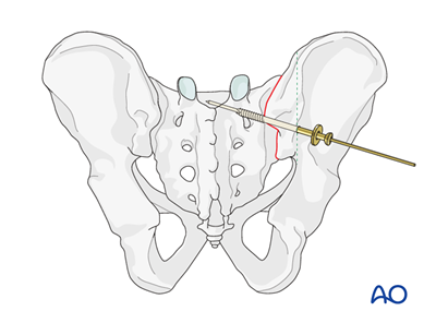 Iliosacral screw for SI joint