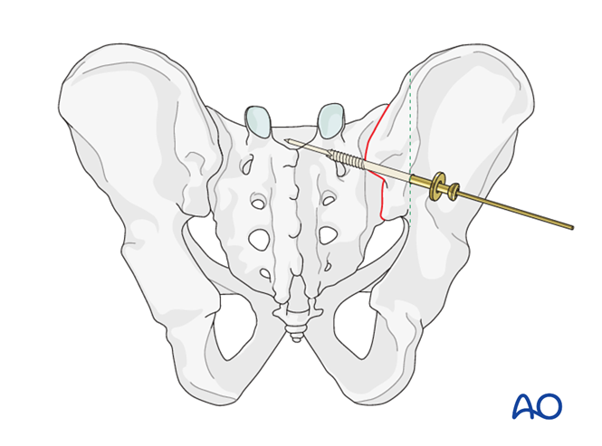 Iliosacral screw for SI joint
