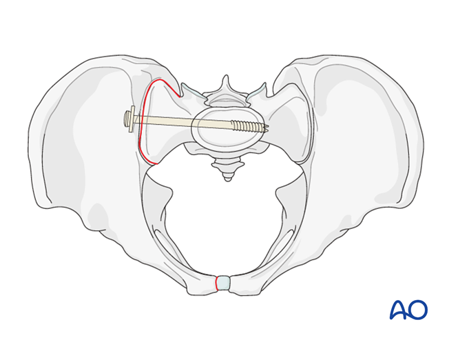 Iliosacral screw for SI joint