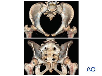 Iliosacral screw for sacrum