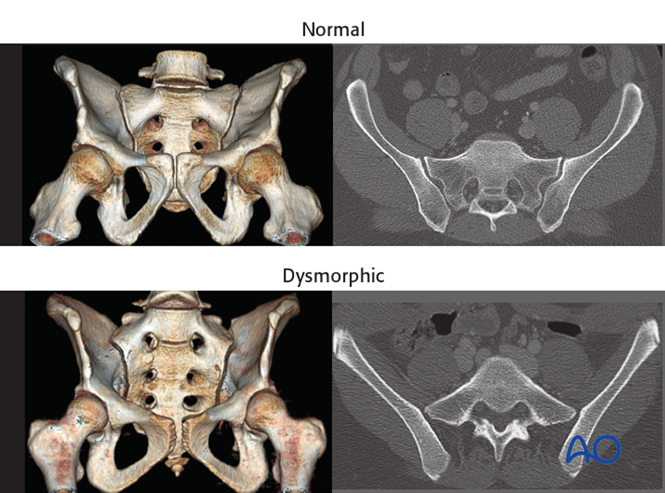 Iliosacral screw for sacrum