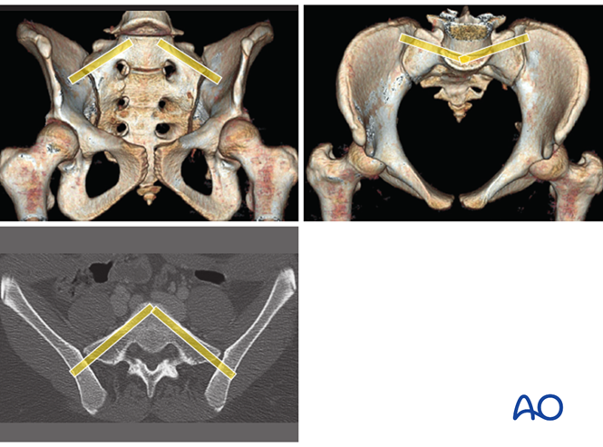 Iliosacral screw for SI joint
