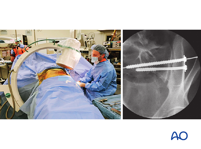 Iliosacral screw for sacrum