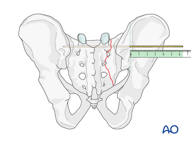 Iliosacral screw for sacrum