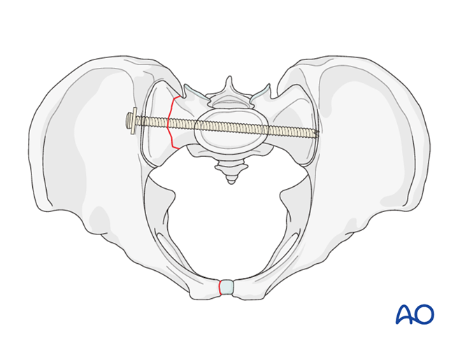 Iliosacral screw for sacrum