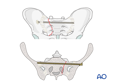 Iliosacral screw for sacrum
