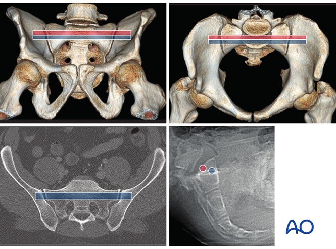 Iliosacral screw for sacrum