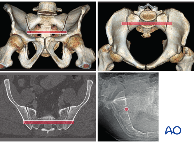 Iliosacral screw for sacrum