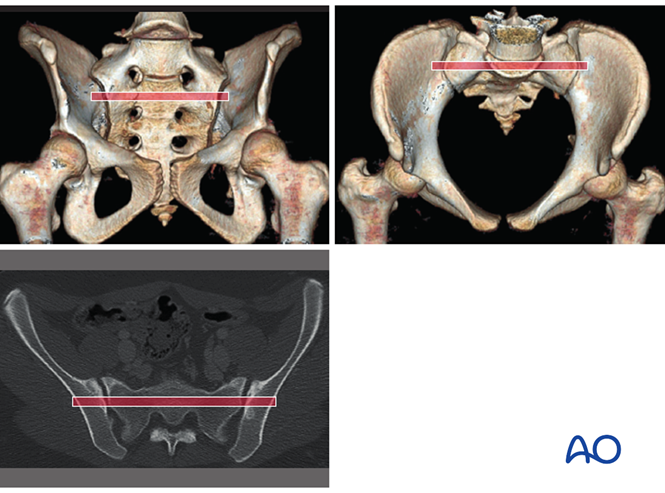 Iliosacral screw for sacrum