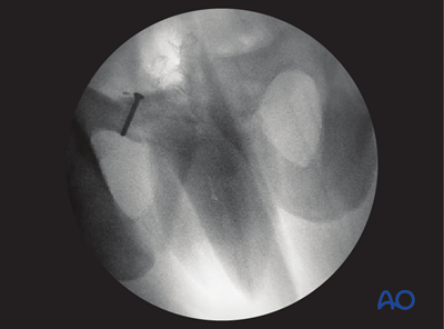 ORIF - Pubic ramus plate for Pubic ramus fractures