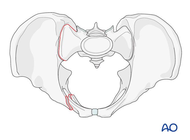 ORIF - Pubic ramus plate for Pubic ramus fractures