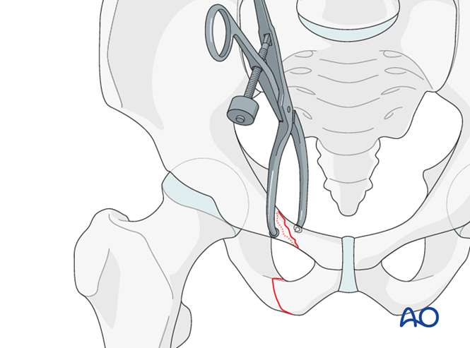 ORIF - Pubic ramus plate for Pubic ramus fractures