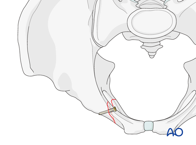 ORIF - Pubic ramus plate for Pubic ramus fractures