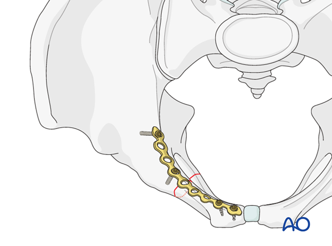 ORIF - Pubic ramus plate for Intact posterior arch, uni- or bilateral ...