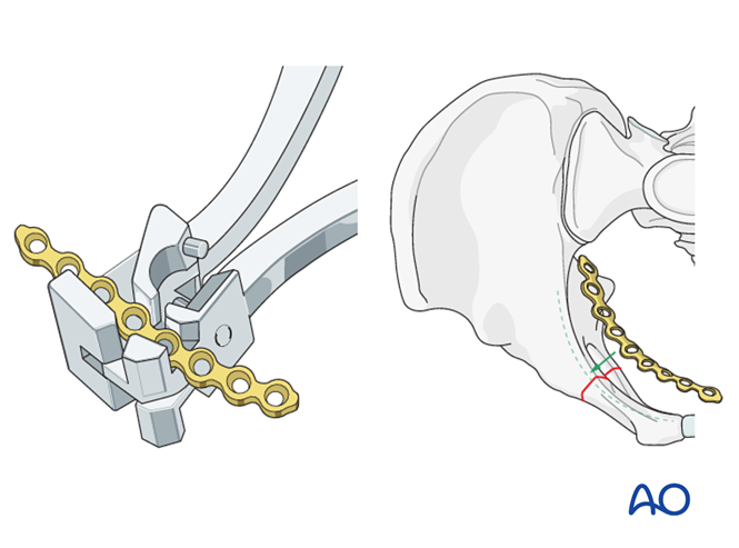 ORIF - Pubic ramus plate for Intact posterior arch, uni- or bilateral ...