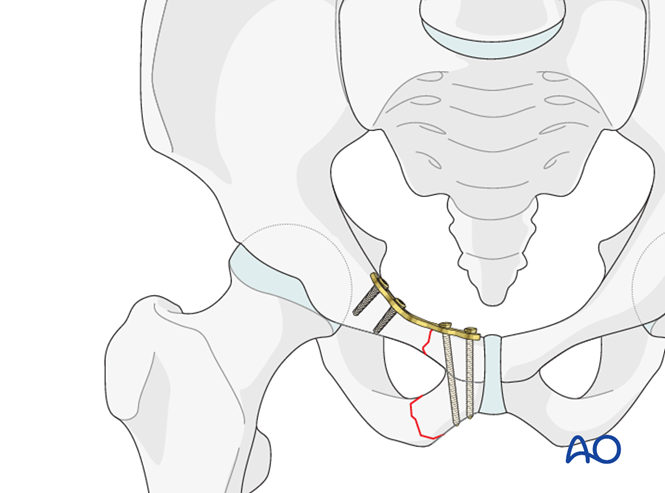 ORIF - Pubic ramus plate for Pubic ramus fractures