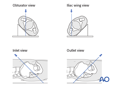ORIF - Pubic ramus plate for Pubic ramus fractures