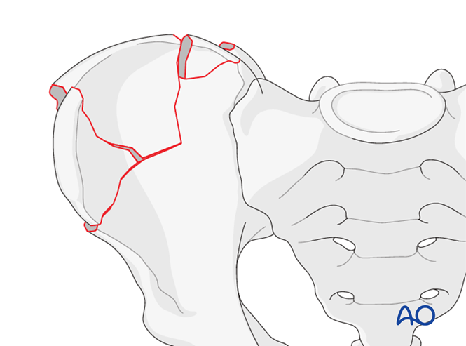 ORIF - Iliac crest for Stable ring fractures