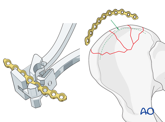ORIF - Iliac crest for Stable ring fractures