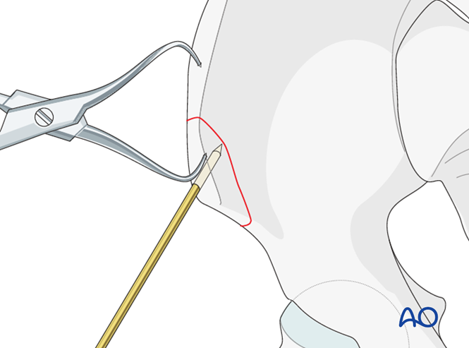 ORIF - Apophyseal avulsion fracture for Stable ring fractures