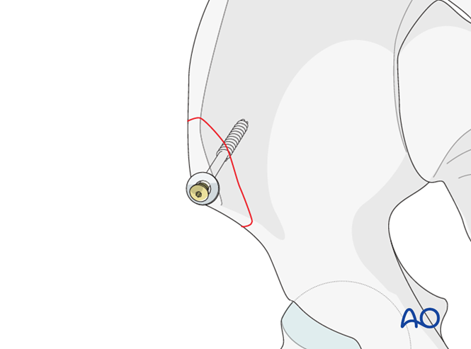 ORIF - Apophyseal avulsion fracture for Stable ring fractures