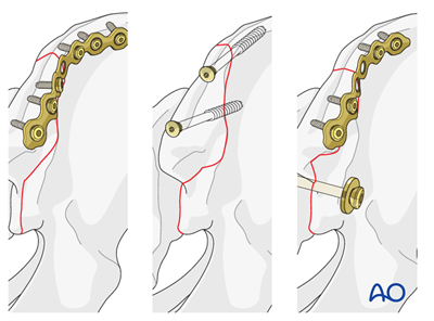 ORIF - Posterior SI fracture fixation for SI-joint fractures