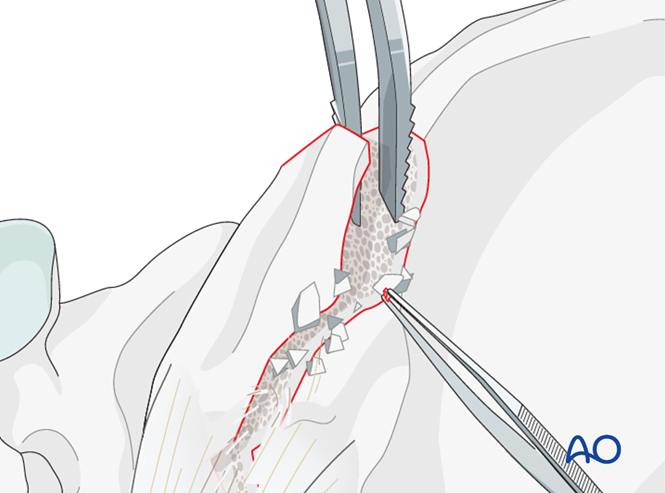 ORIF - Posterior SI fracture fixation for SI-joint fractures