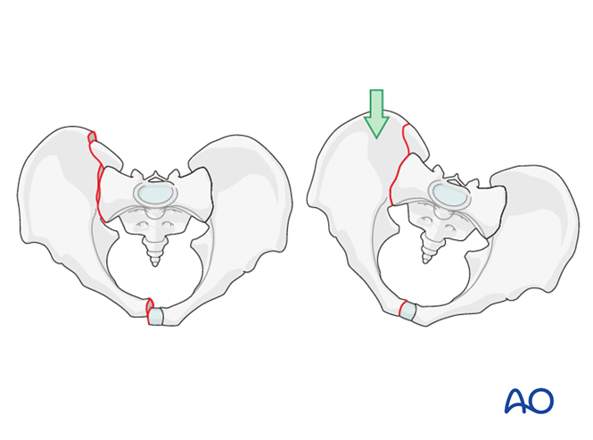ORIF - Posterior SI fracture fixation for SI-joint fractures