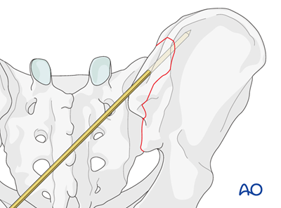 ORIF - Posterior SI fracture fixation for SI-joint fractures