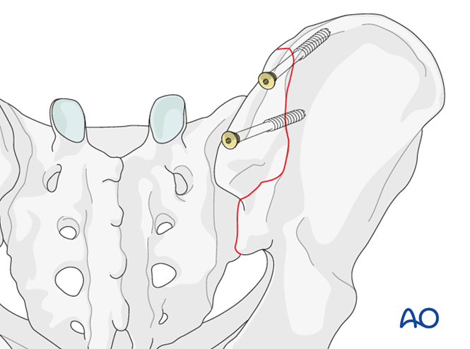 ORIF - Posterior SI fracture fixation for SI-joint fractures