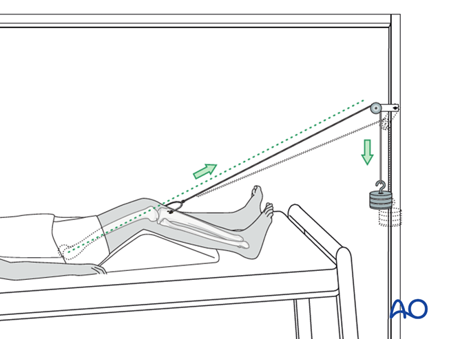 External fixation and traction for Unilateral complete, contralateral ...