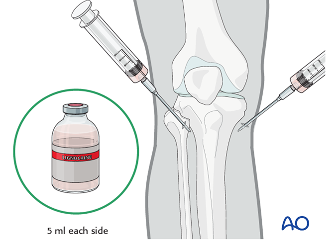External fixation and traction for Iliac fractures