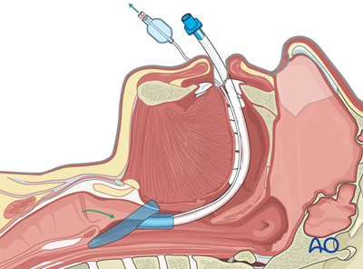 Airway for Primary survey