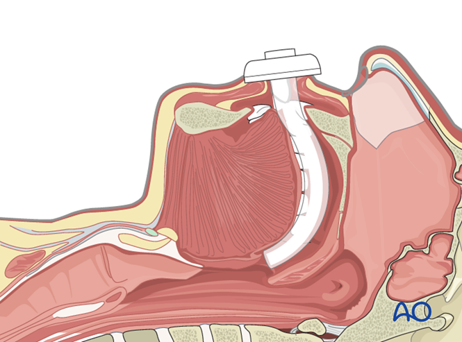 Airway for Primary survey