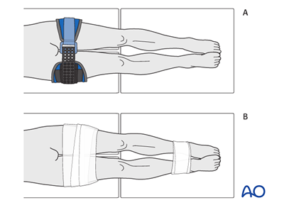 Extraperitoneal pelvic packing for Acute pelvic treatment