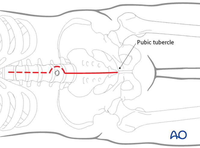Extraperitoneal pelvic packing for Acute pelvic treatment