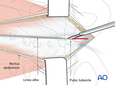 Extraperitoneal pelvic packing for Acute pelvic treatment