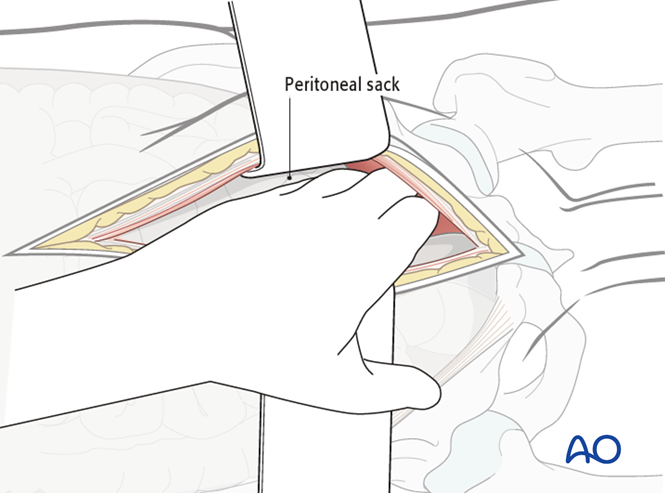 Extraperitoneal pelvic packing for Acute pelvic treatment