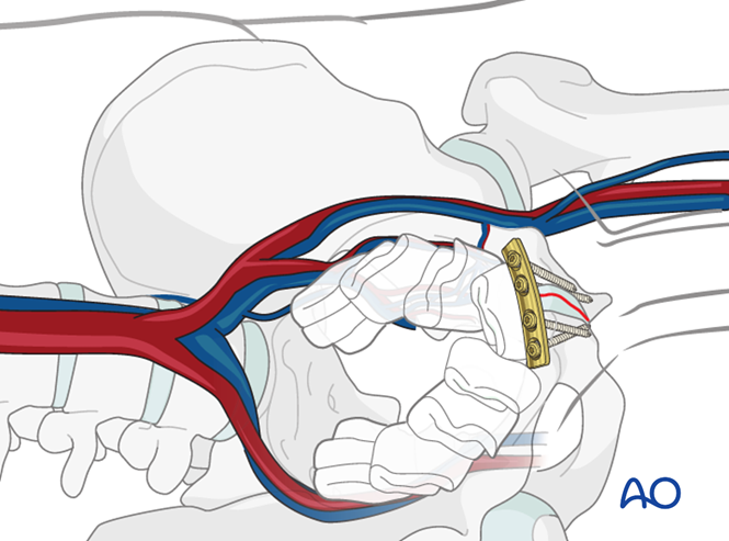 Extraperitoneal pelvic packing for Acute pelvic treatment