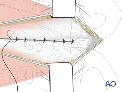Extraperitoneal pelvic packing for Acute pelvic treatment