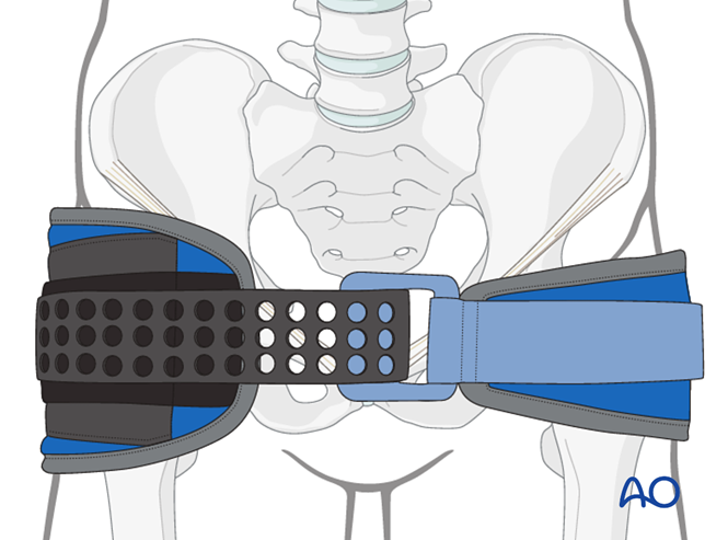 Angio embolization for Acute pelvic treatment