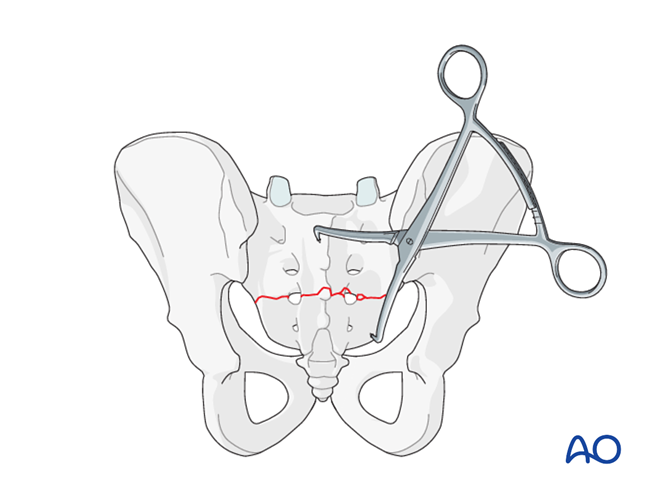 ORIF Plate for Intact posterior arch, displaced transverse sacral fracture