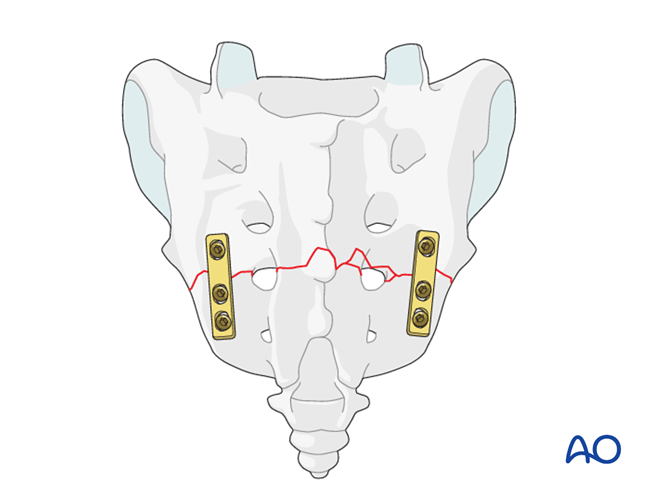 ORIF Plate for Intact posterior arch, displaced transverse sacral fracture