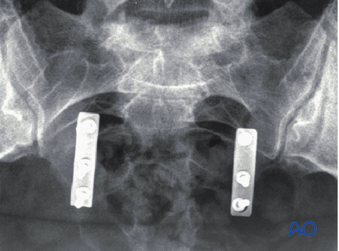 ORIF Plate for Intact posterior arch, displaced transverse sacral fracture