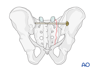 Operative treatment for Unilateral complete disruption of posterior ...