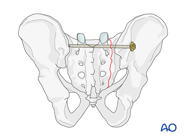 Operative treatment for Incomplete disruption of posterior arch, open ...