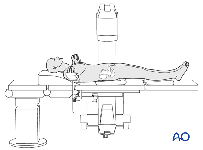 Operative treatment for Incomplete disruption of posterior arch, open ...