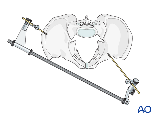 Operative treatment for Incomplete disruption of posterior arch ...